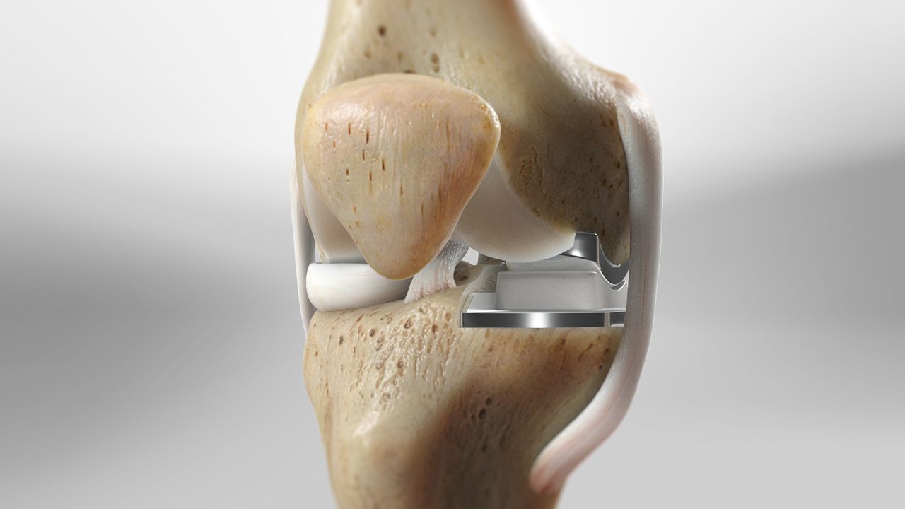 Partial Knee Replacement Dr Rahul Bade Partial Knee Replacement Dr Rahul Bade