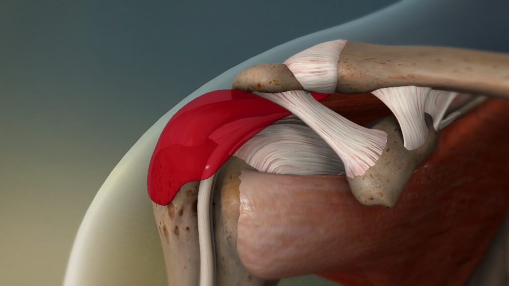 Subacromial Bursitis Doctor in Pune, India | Shoulder Bursitis ...